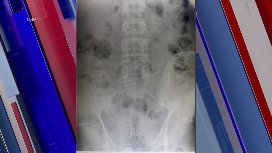 American found smuggling fentanyl inside body - KVIA