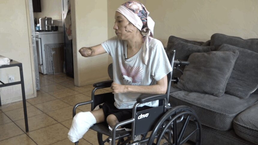 Mom survives flesh-eating infection, faces life with amputations - KVIA